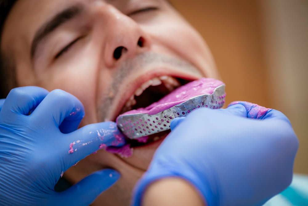 Materials and Techniques for Taking Dental Impressions