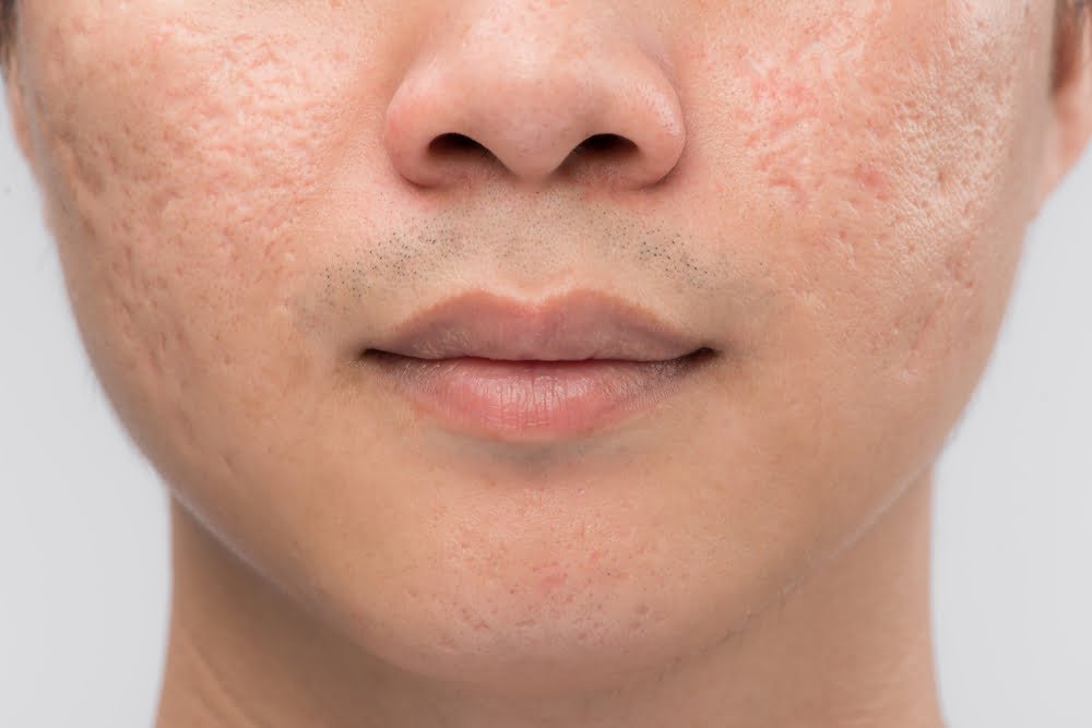 Diagnosing and Finding the Best Treatments for Acne Scars